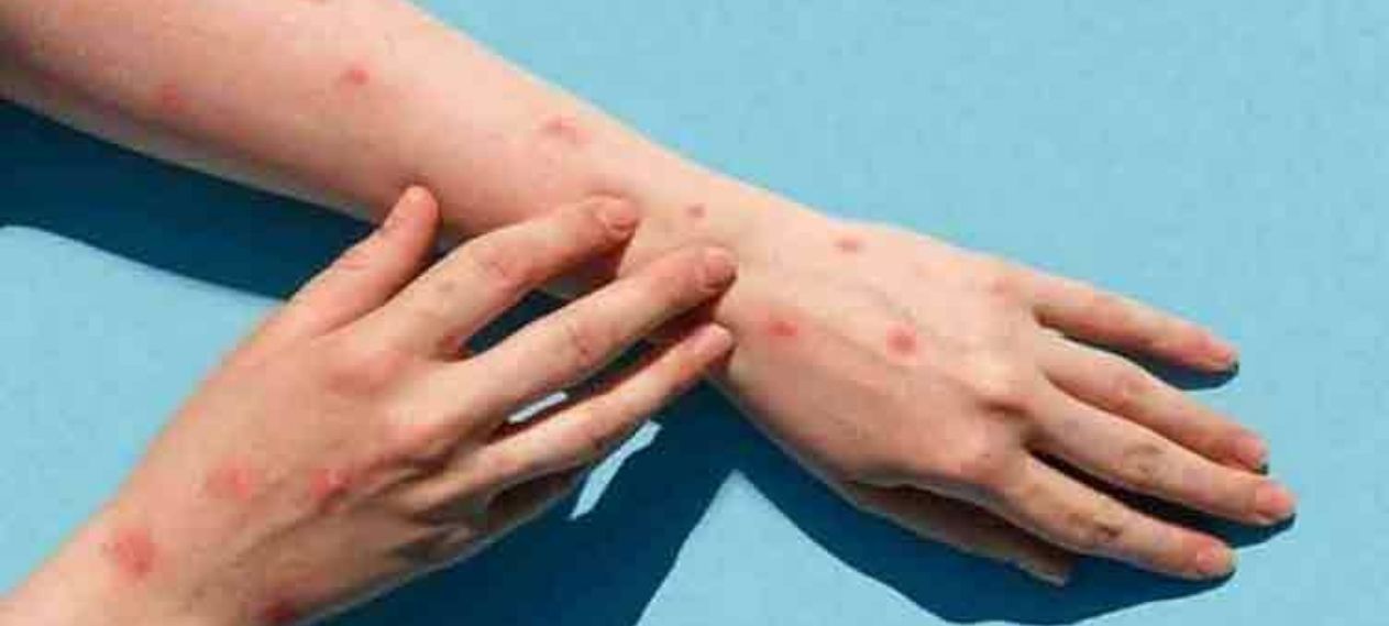 New Monkeypox Case Confirmed in Pakistan from Gulf Returnee